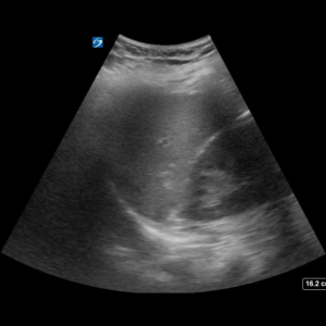 FAST Ultrasound Trauma Detection on Edge Device – Center for Applied AI